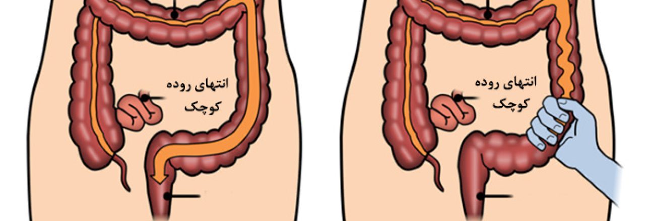 سندرم یا بیماری روده تحریک پذیر (آی بی اس IBS): علایم و درمان - دکتر ...